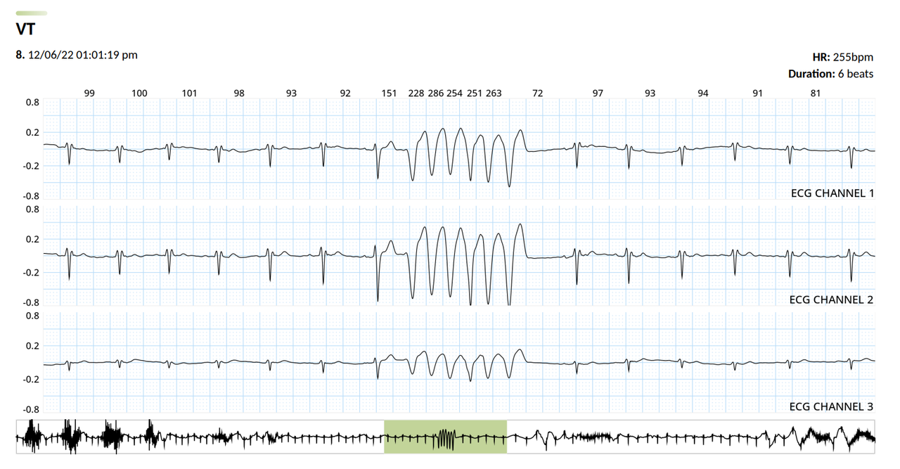 Asymptomatic run of 6 beats NSVT. My doctor wants me to get a nuclear ...