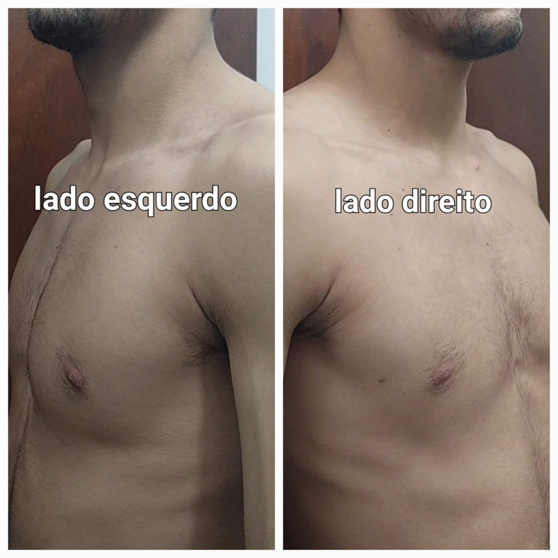 Estou Com Um Peito Maior Que O Outro Treinamento Fórum Hipertrofia