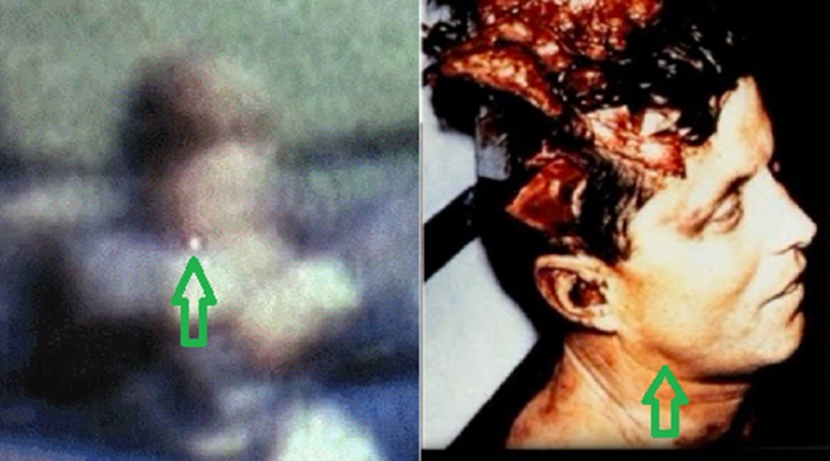 The Zapruder film used in Oliver Stone's JFK movie depicts a frontal ...