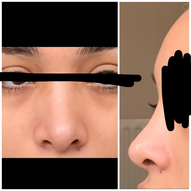 Is my 2nd rhinoplasty botched? (10 days post op) : r/PlasticSurgery