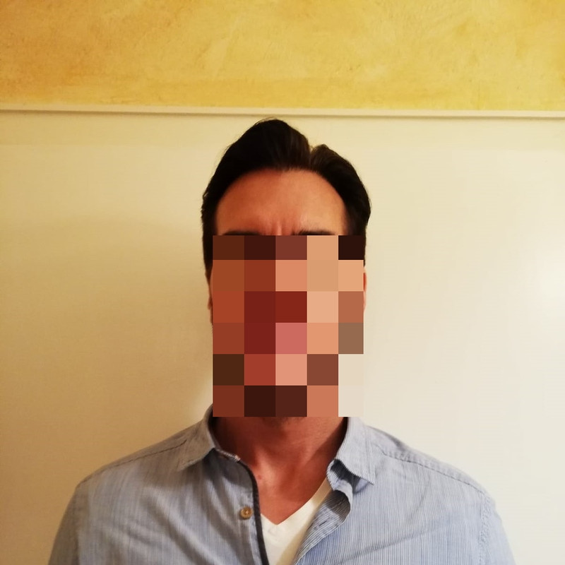 Dr. Kaan Pekiner 2001 grafts FUE dense pack Bellicapelli Forum