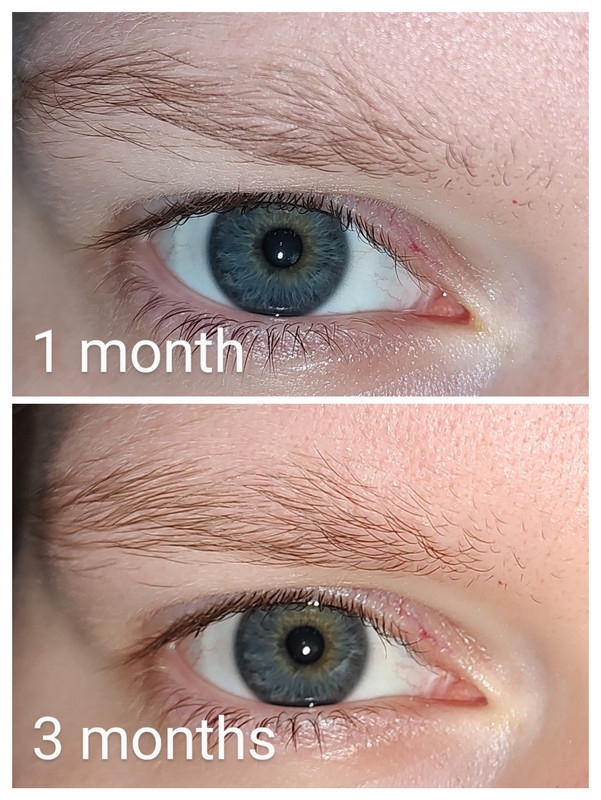 Eyebrows filling in on oral minoxidil : r/FemaleHairLoss