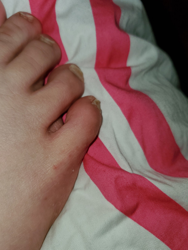 Small, itchy red spots on foot : r/DoctorsAdvice