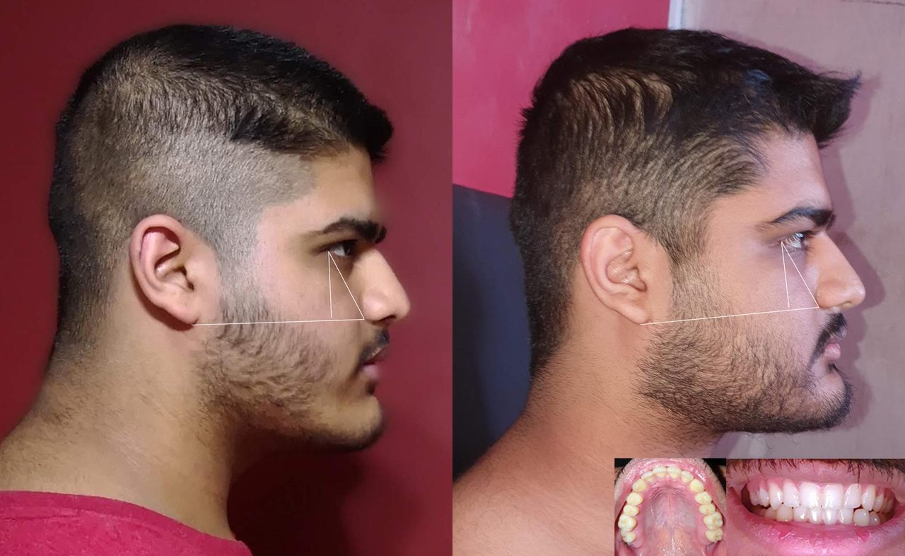 19M 10 Months Mewing Transformation (6'5 145kg) : r/orthotropics