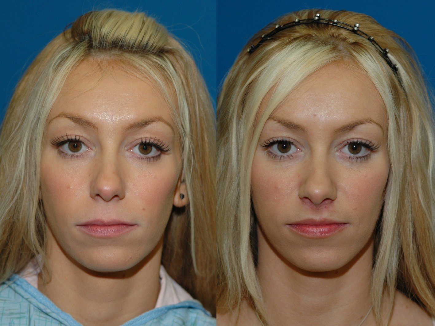 before and after philtrum shortening — Postimages