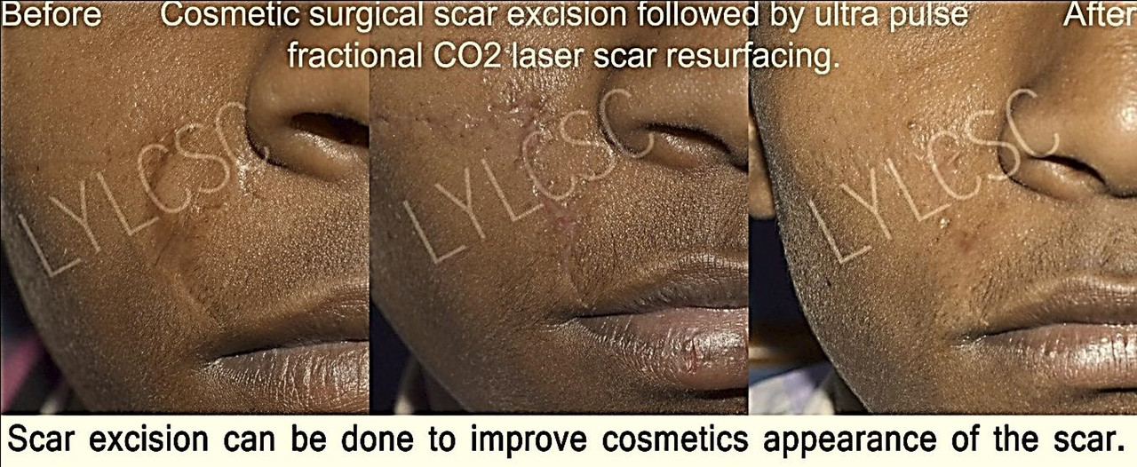 Body Scars Treatment – Look Young Laser & Cosmetic Surgery Center