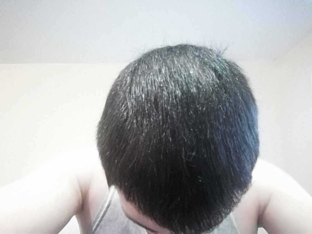 Dr. Kaan Pekiner 3003 grafts FUE (de los cuales 711 de la barba) en NW3 ...