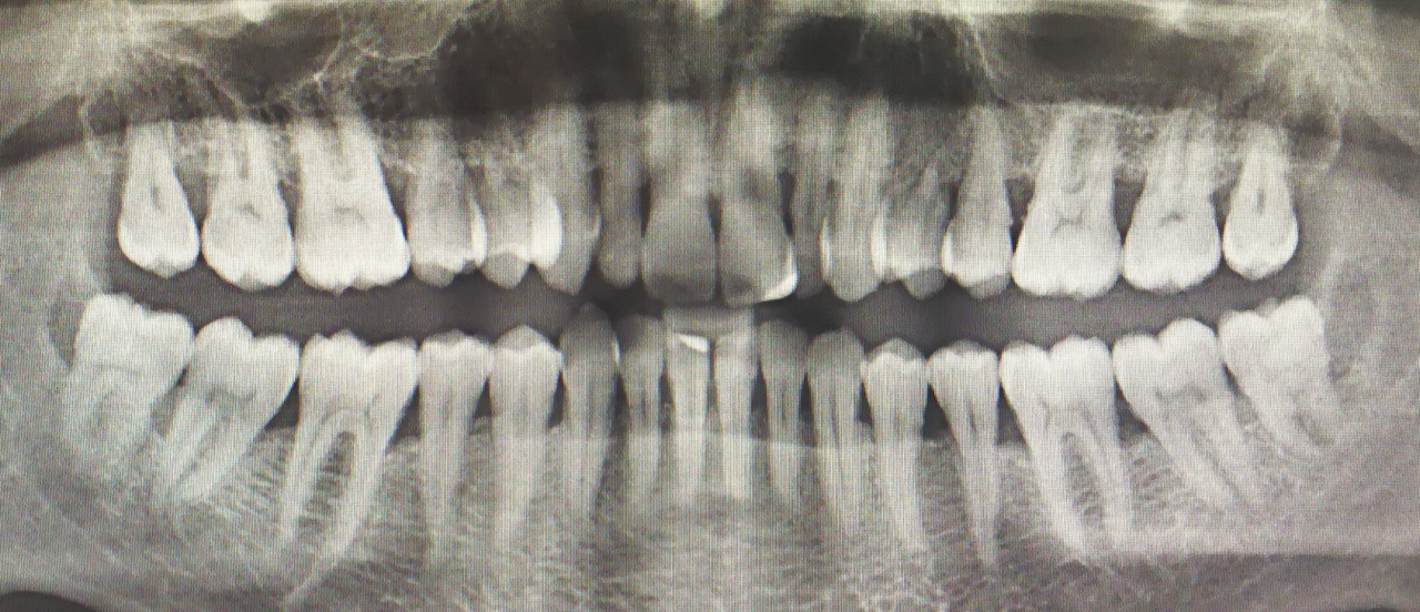 Which alignment method to choose for 2 shifted upper lateral incisors ...